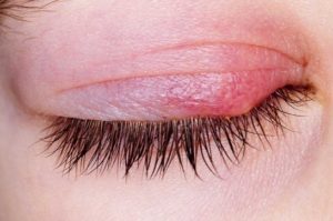 Eczema, or Dermatitis, Involving the Skin of the Eyelids, also known as ...