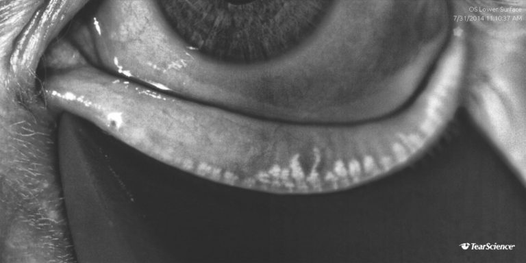 Diagnosing Ocular Rosacea | The Dry Eye Treatment Center