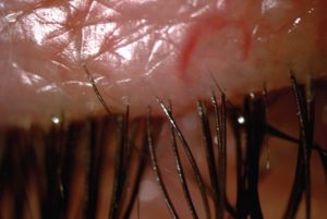 Treating Demodex | The Dry Eye Treatment Center