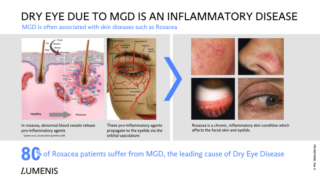 Treating MGD | The Dry Eye Treatment Center