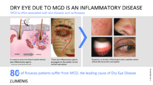 Treating MGD | The Dry Eye Treatment Center